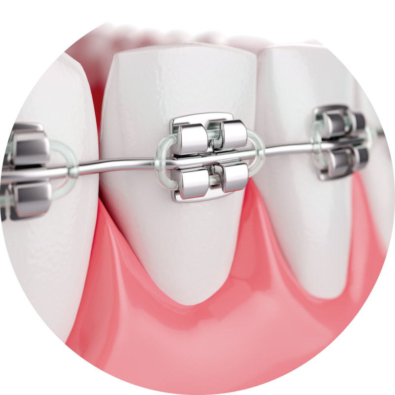 Ortodoncia con Invisalign o Brackets | 14-85 Dental Spa